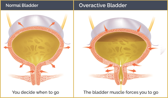 How to Eliminate Urgent Urination? - Veledora health